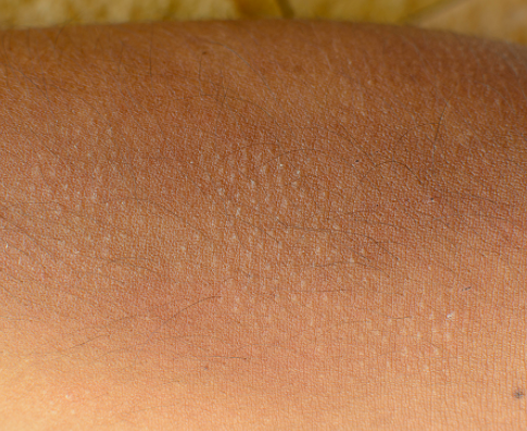 KERATOSIS PILARIS -BEAUTY ON ROSE